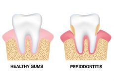 Why Do My Gums Hurt? Reasons and Treatment for Gum Pain - Smile ...