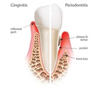 What Is Gum Peeling? - Smile Makeover of LA
