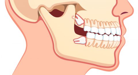 Why Are Some People Born Without Wisdom Teeth? - Smile Makeover of LA