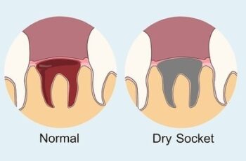What Is a Dry Socket? - Smile Makeover of LA